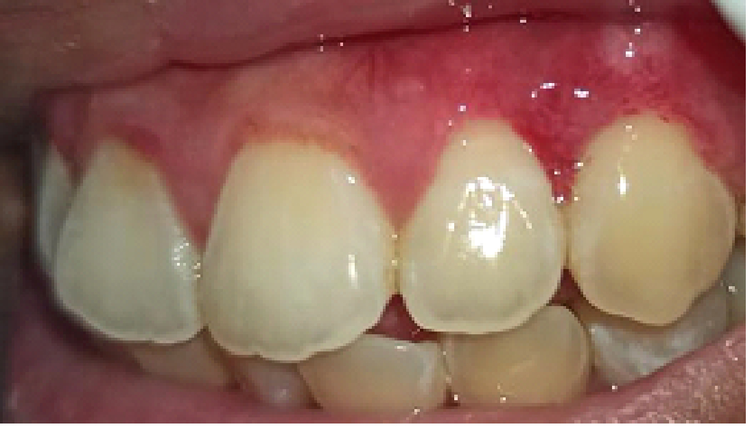 Fibrous Epulis Gingival Epulis: Report Of Two Cases.